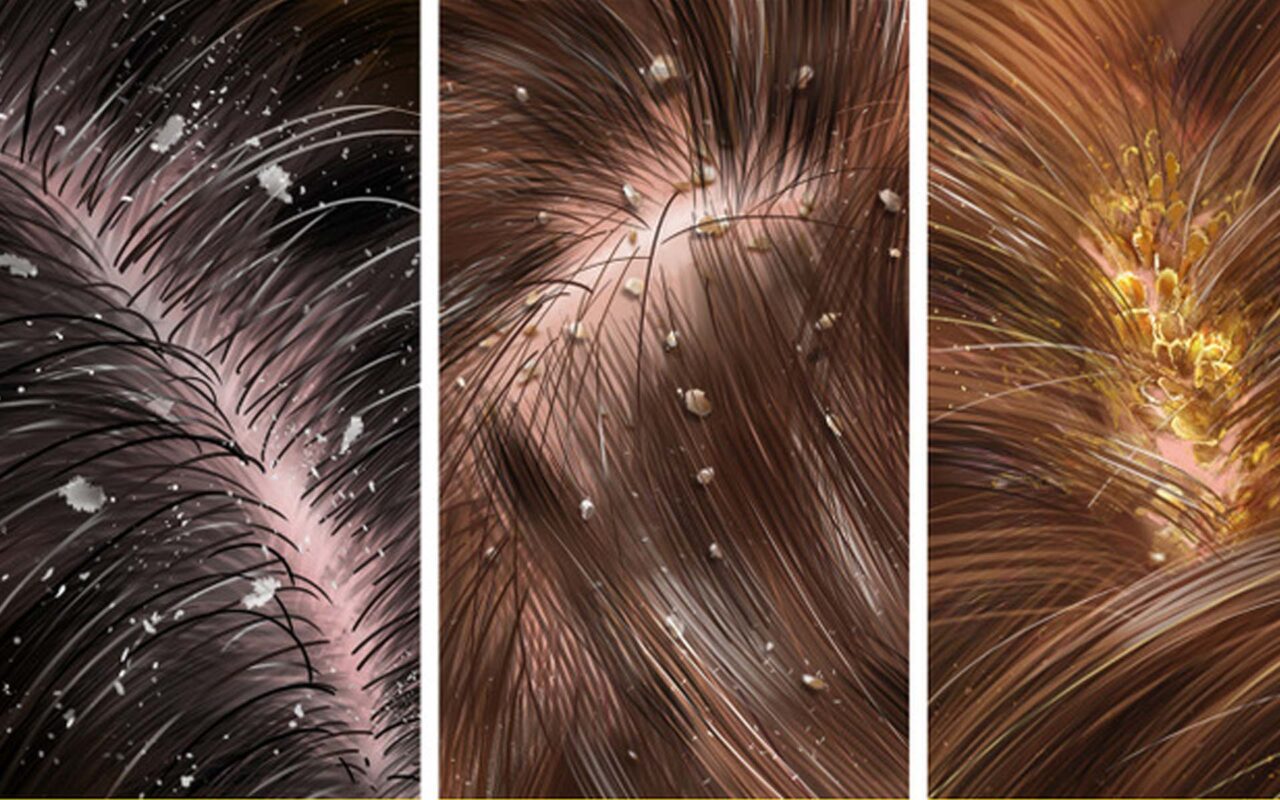 Πιτυρίδα: Γιατί Εμφανίζεται και πώς να την Αντιμετωπίσετε Αποτελεσματικά